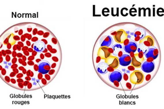 Israël : des chercheurs découvrent un traitement de la leucémie - JForum